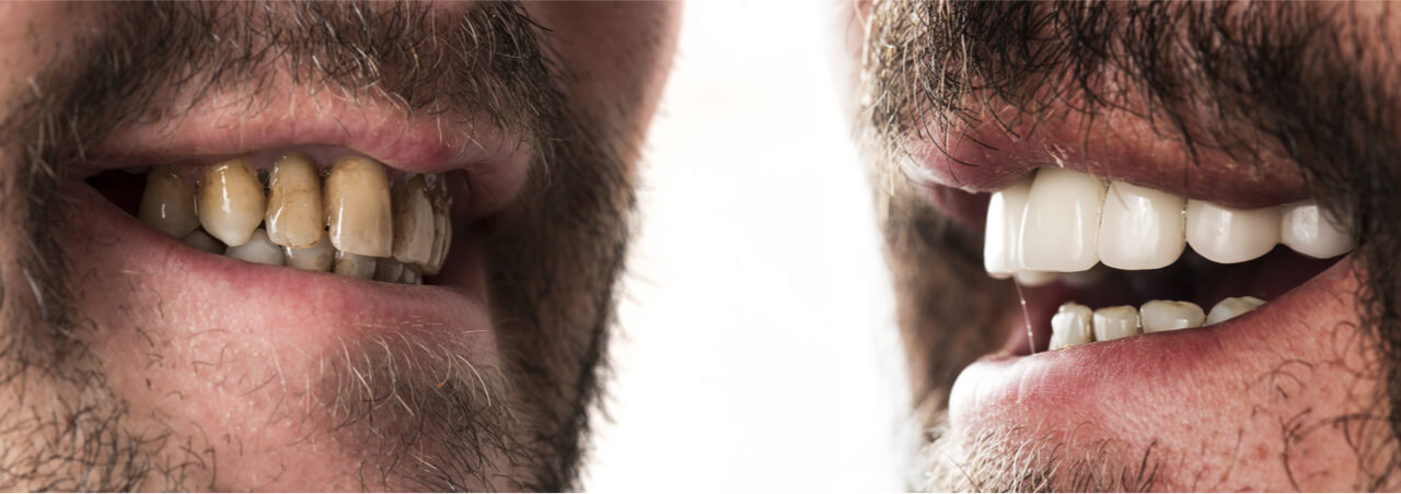 Dental Options For Bad Teeth | mywellnesshouse.com